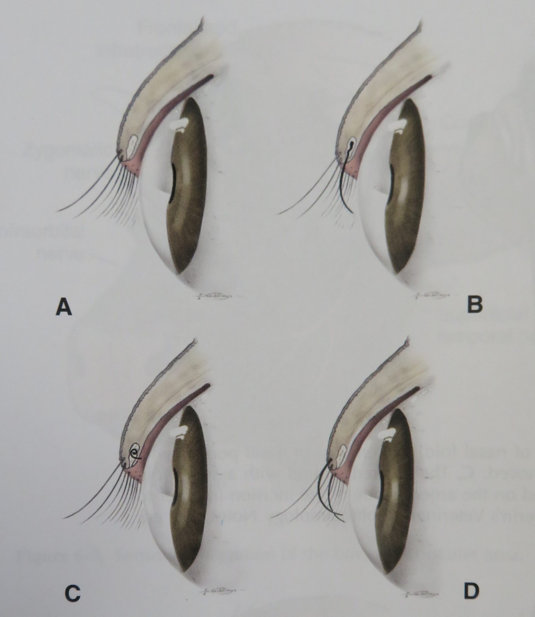 Eyelash Disorders: Distichiasis or Ectopic Cilia or Trichiasis ...
